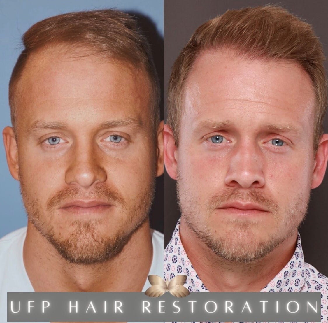 Why Some Need Multiple Hair Transplants - Utah Hair Restoration
