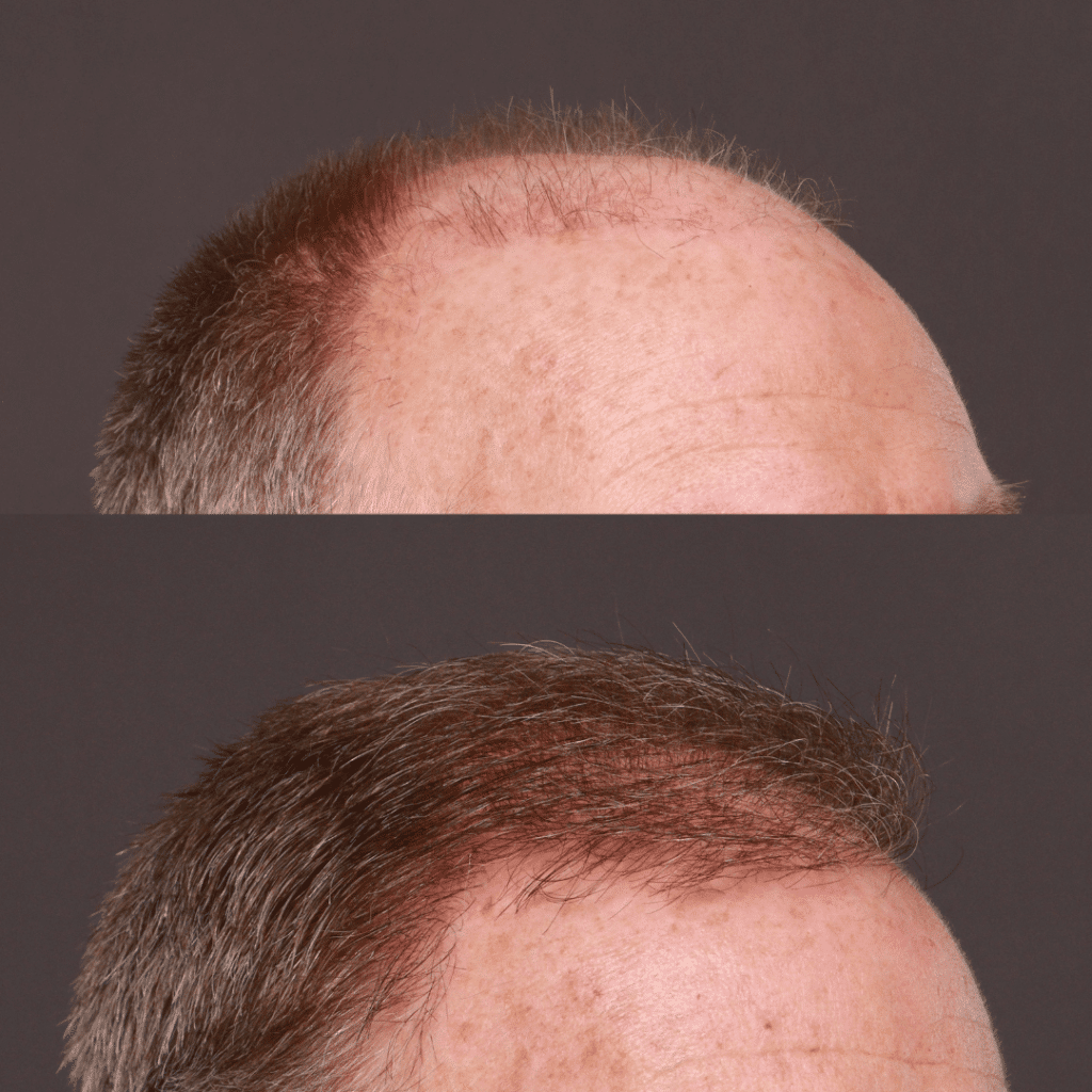 Hair Transplant Strip Method (FUT) Salt Lake City, Utah