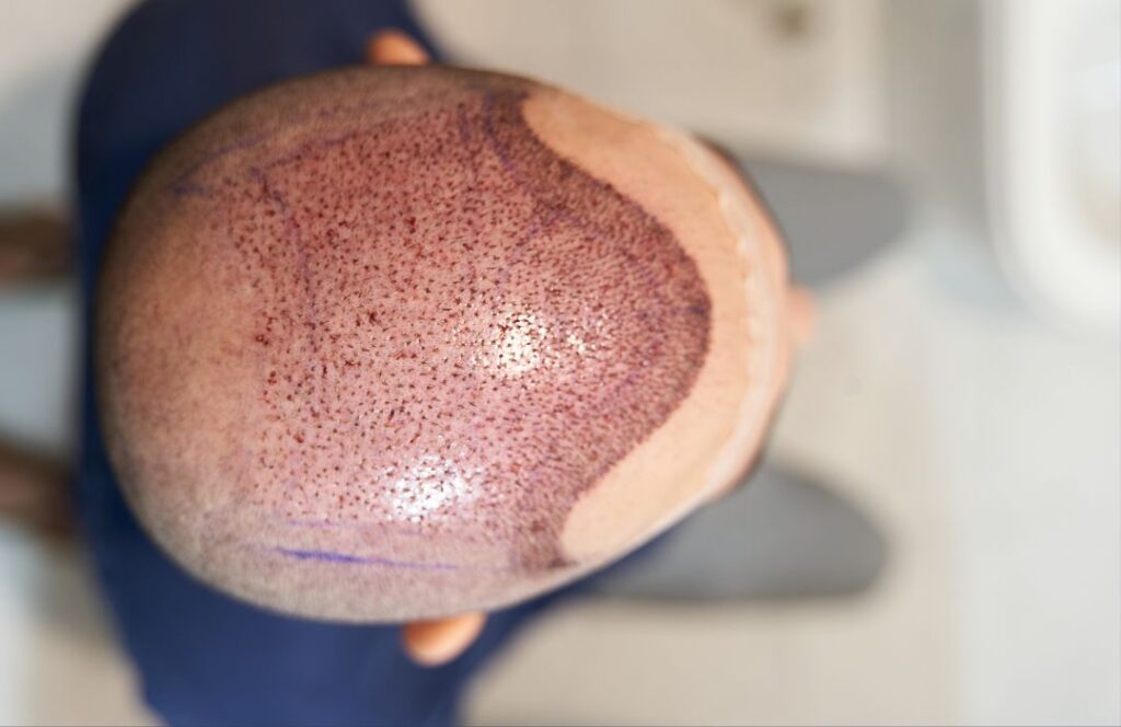 Donor Area After a Hair Transplant Draper UT - Hair Donor Layton